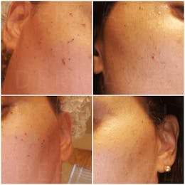 Before And After Dermavel